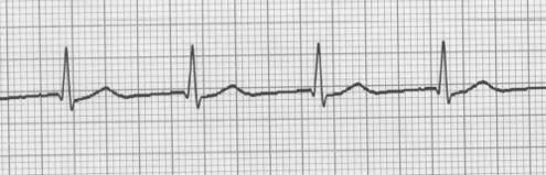P wave after the QRS: